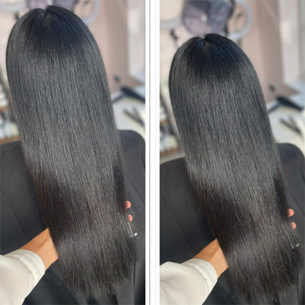 Combined Botox from RG Hairline - Chatsumer